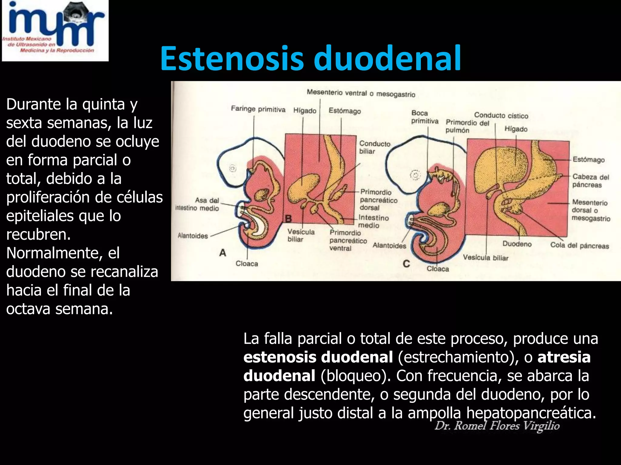 Defectos de la pared abdominal fetal.ppt para slsh | PPT