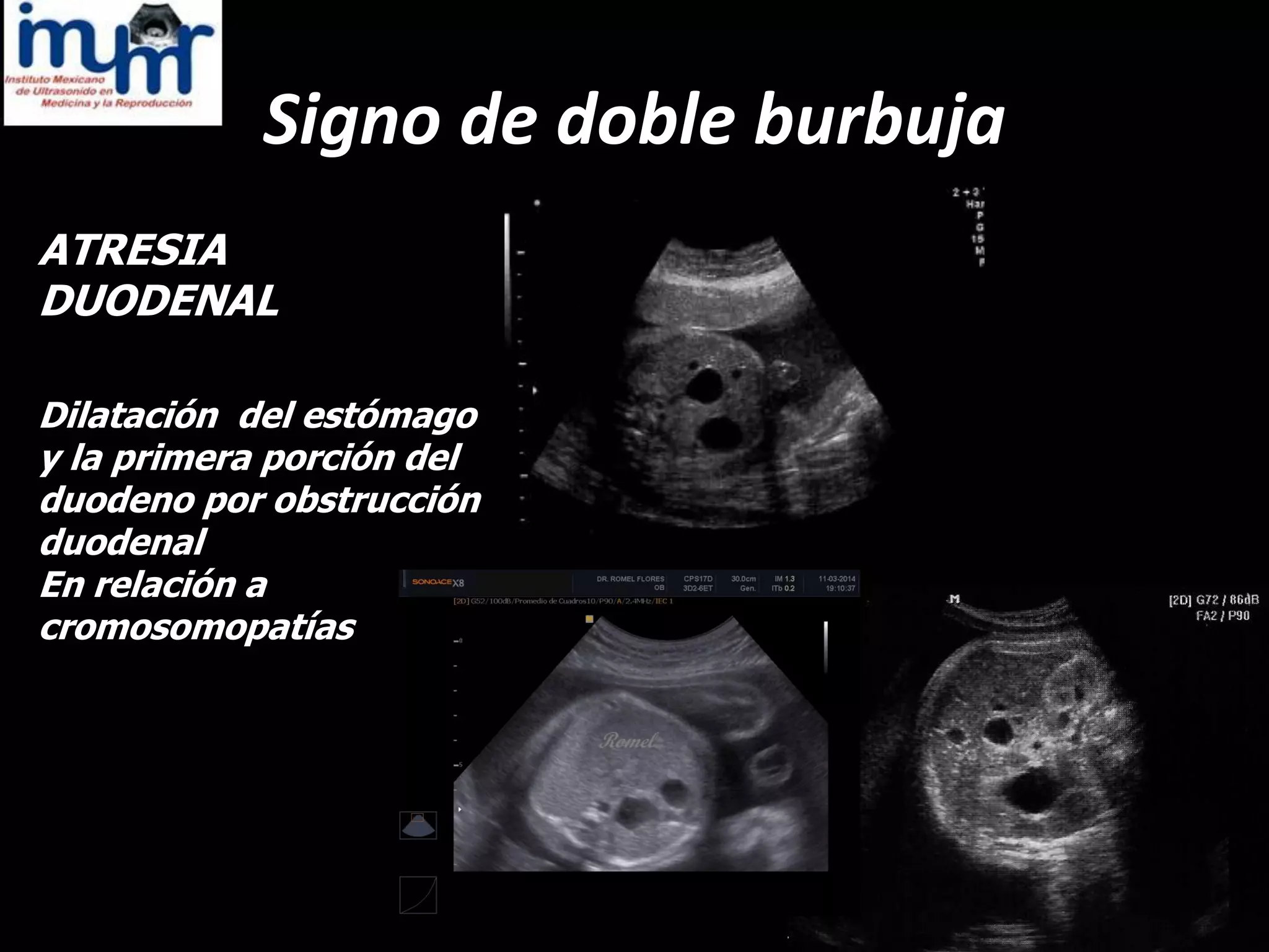 Defectos de la pared abdominal fetal.ppt para slsh | PPT