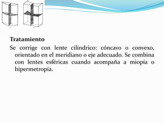 Defectos de la refraccion | PPTX