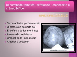 Defectos del tubo neural | PPTX | Pregnancy | Reproductive Health
