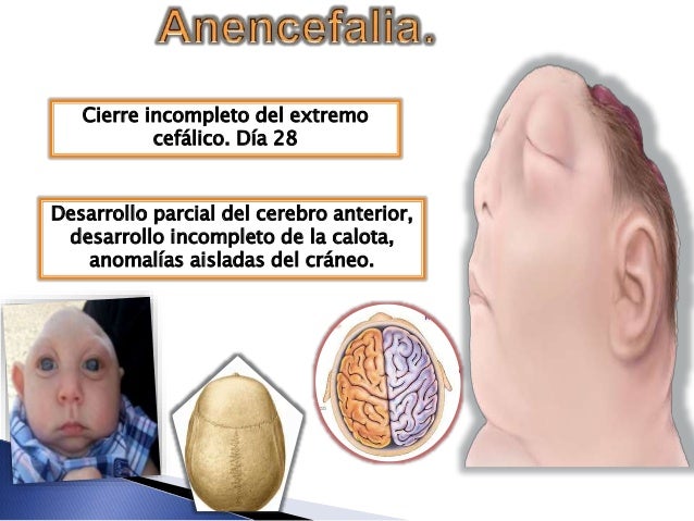 Defectos del tubo neural