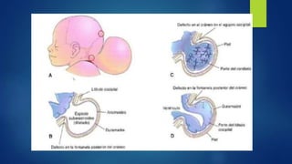 DEFECTOS DEL TUBO NEURAL pediatría .pptx