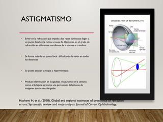 Defectos de refracción. Ofatlmologia médica | PPTX
