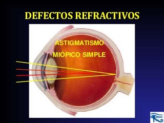Defectos refractivos | PPTX