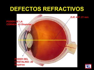 Defectos refractivos | PPTX