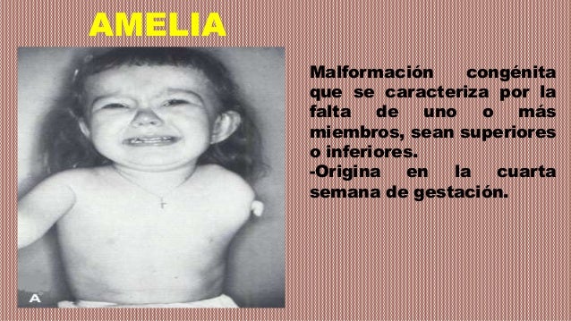 Defectos teratogenicos del desarrollo embrionario Dr. JACIEL