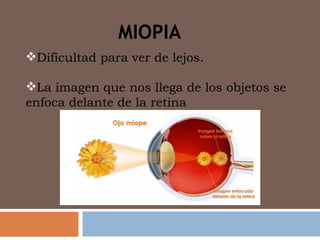Defectos de la vision | PPT