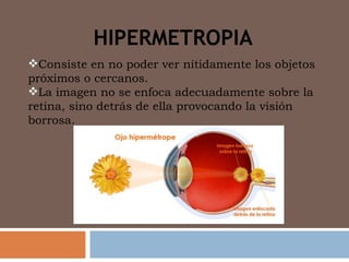 Defectos de la vision | PPT