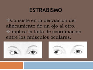 Defectos de la vision | PPT