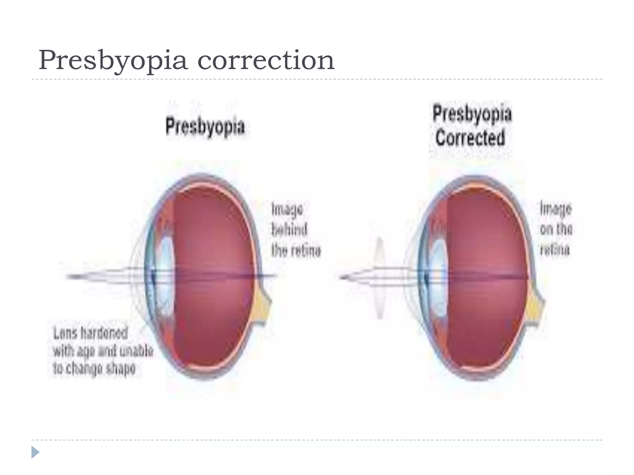 Defects of eye | PPTX