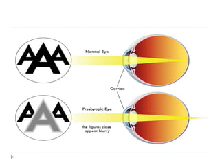 Defects of eye | PPT
