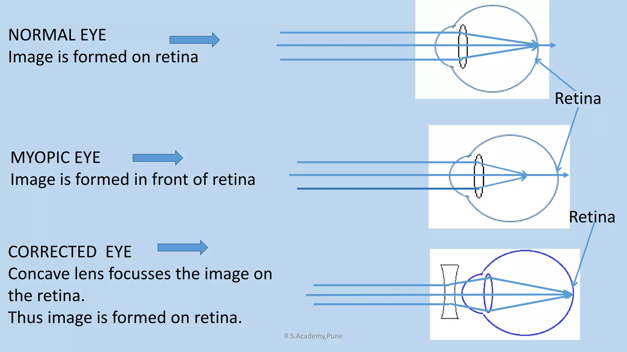 Defects of human eye | PPTX