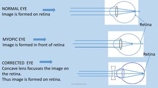 Defects of human eye | PPTX