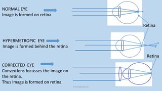 Defects of human eye | PPTX