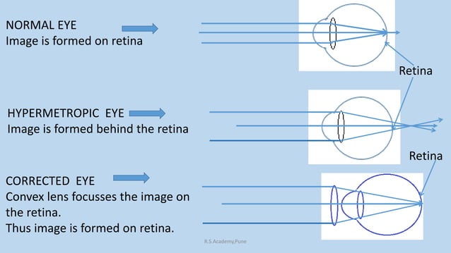 Defects of human eye | PPT