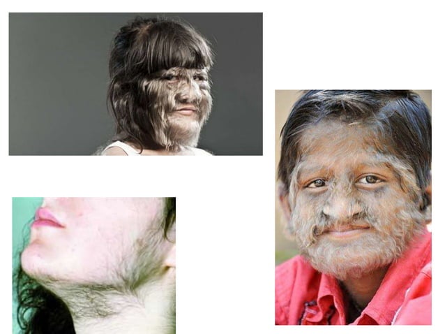 Defects of the hair shaft level 3 | PPT