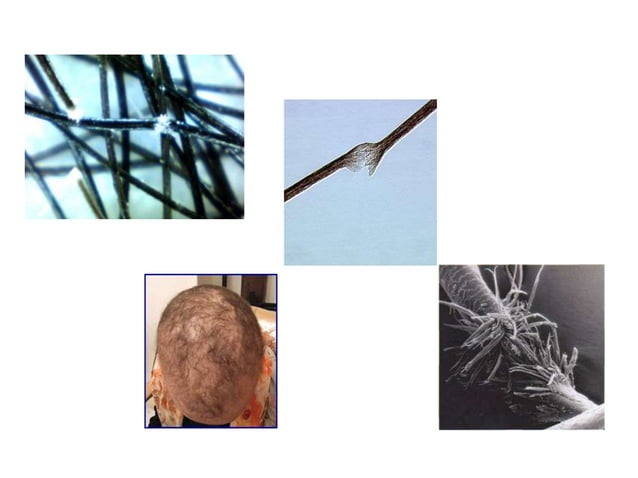 Defects of the hair shaft level 3 | PPT