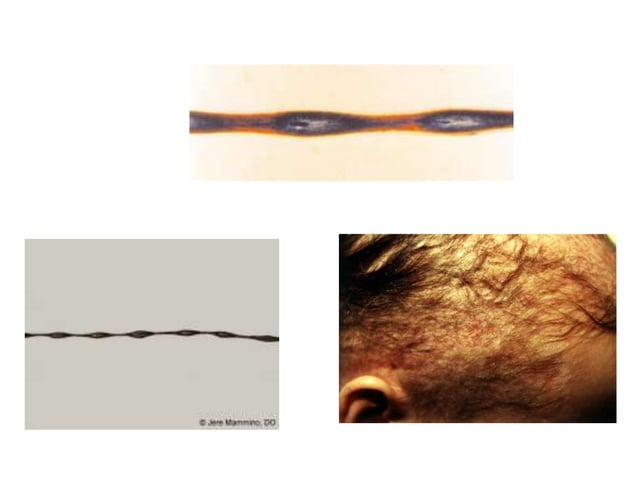 Defects of the hair shaft level 3 | PPT