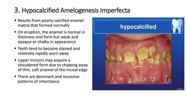 Defects of tooth structure | PPTX | Dental Health | Diseases and Conditions