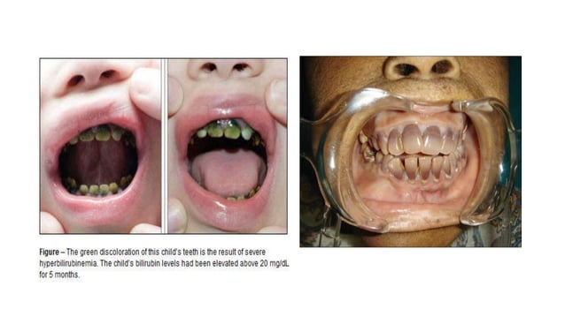 Defects of tooth structure | PPTX | Dental Health | Diseases and Conditions