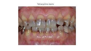 Defects of tooth structure | PPTX