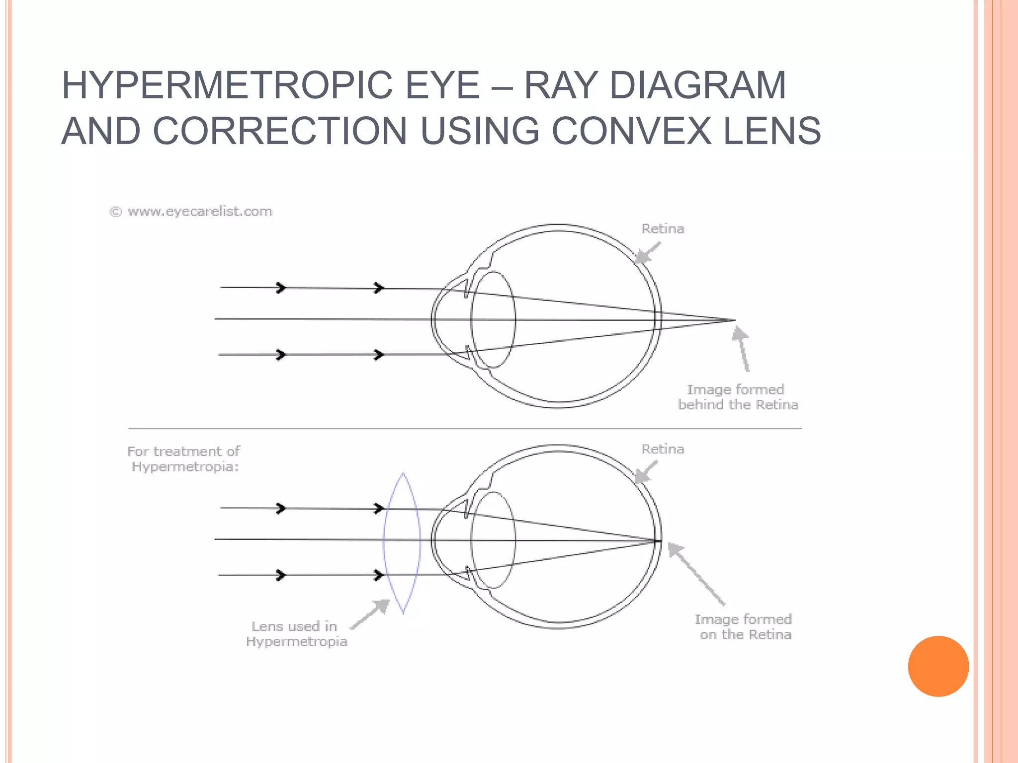 Defects of vision | PPTX