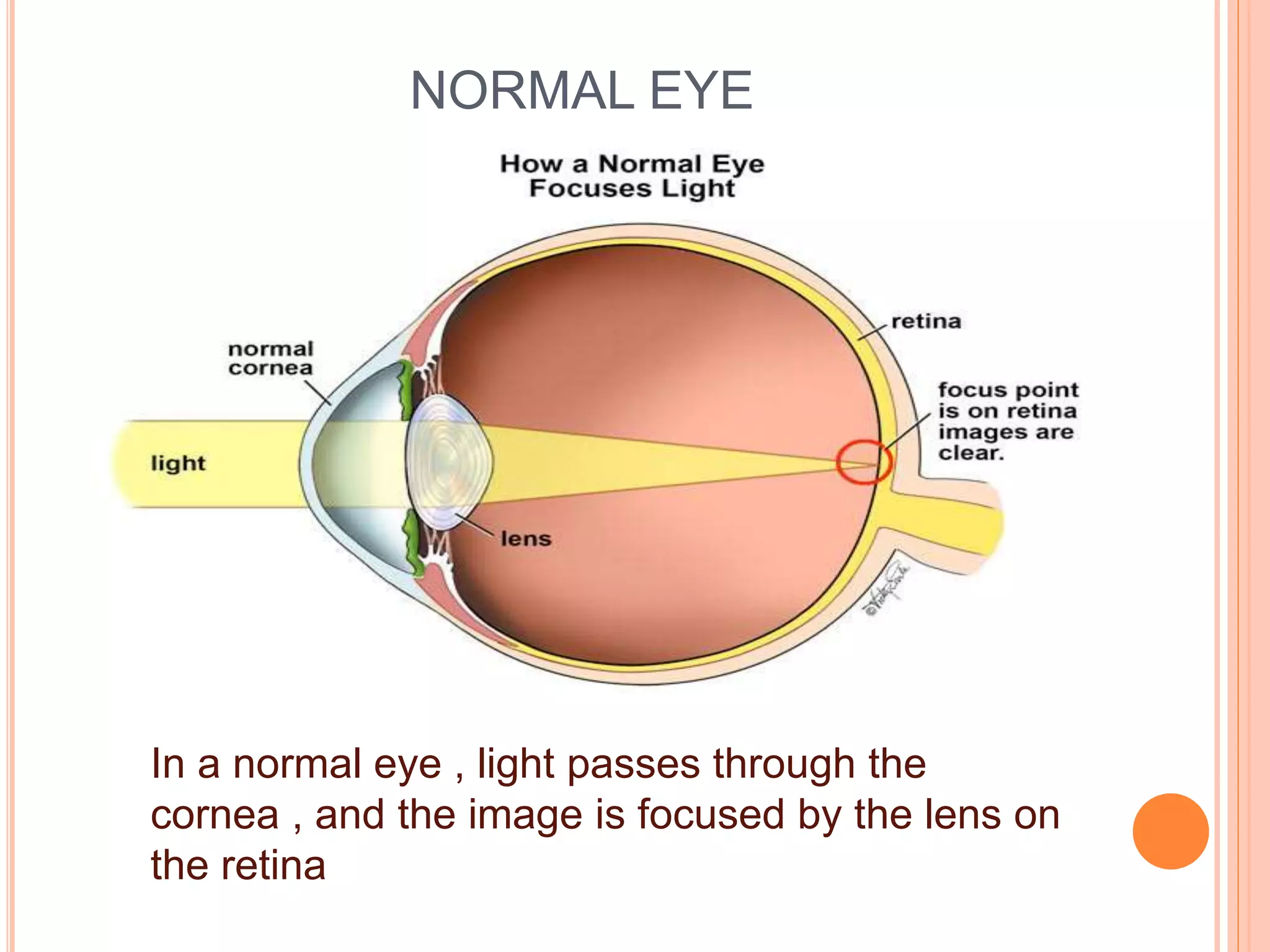 Defects of vision | PPTX