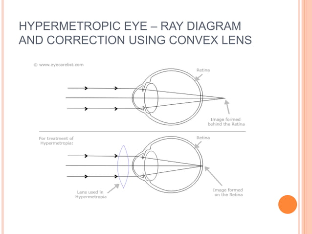 Defects of vision | PPTX | Eye and Vision Conditions | Diseases and ...