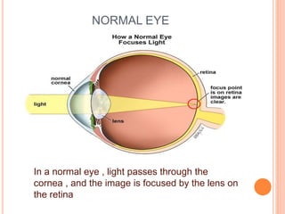 Defects of vision | PPTX