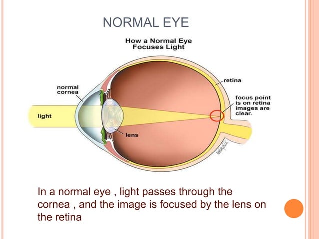 Defects of vision | PPT