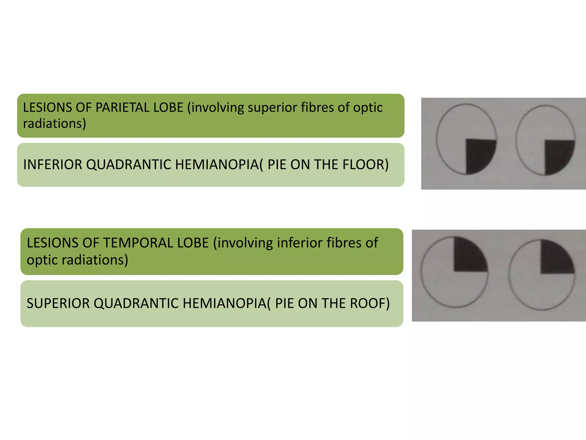 Defects of visual pathway | PPTX