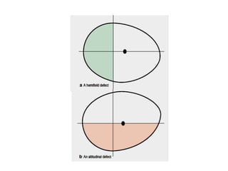 Defects of visual pathway | PPTX