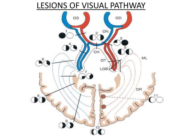 Defects of visual pathway | PPTX