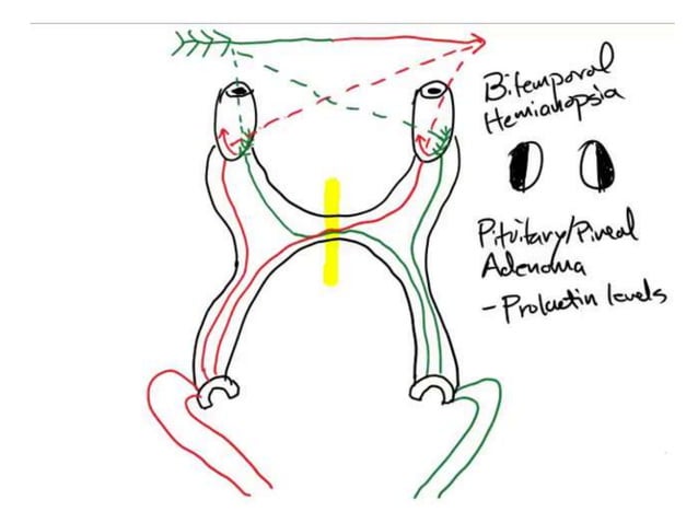 Defects of visual pathway | PPTX