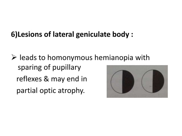 Defects of visual pathway | PPTX