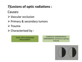 Defects of visual pathway | PPTX