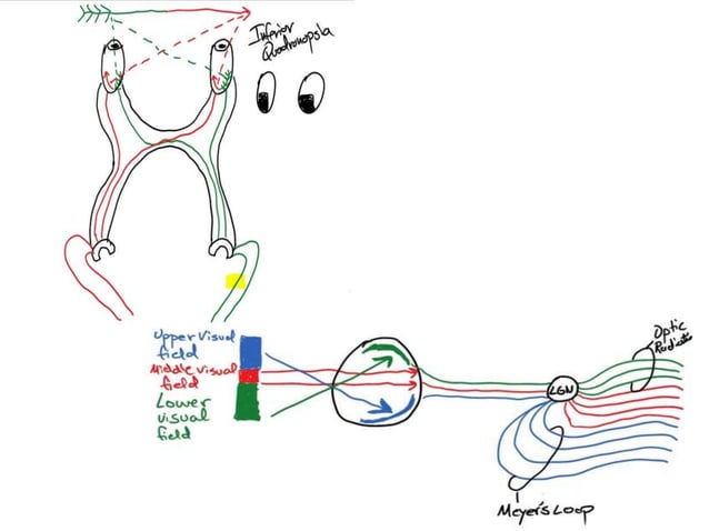 Defects of visual pathway | PPTX