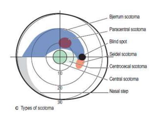 Defects of visual pathway | PPT