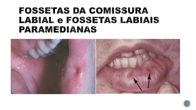 Defeitos do desenvolvimento da região bucal e anomalias