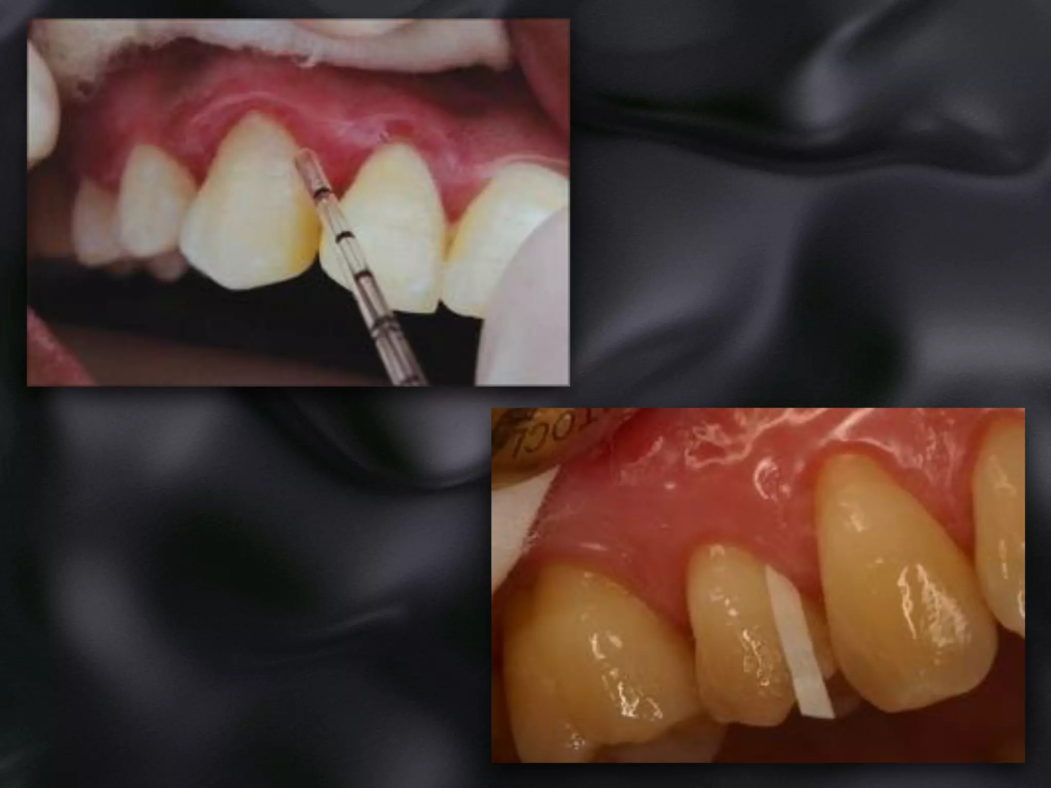 Defence Mechanism Of Oral Cavity | PDF