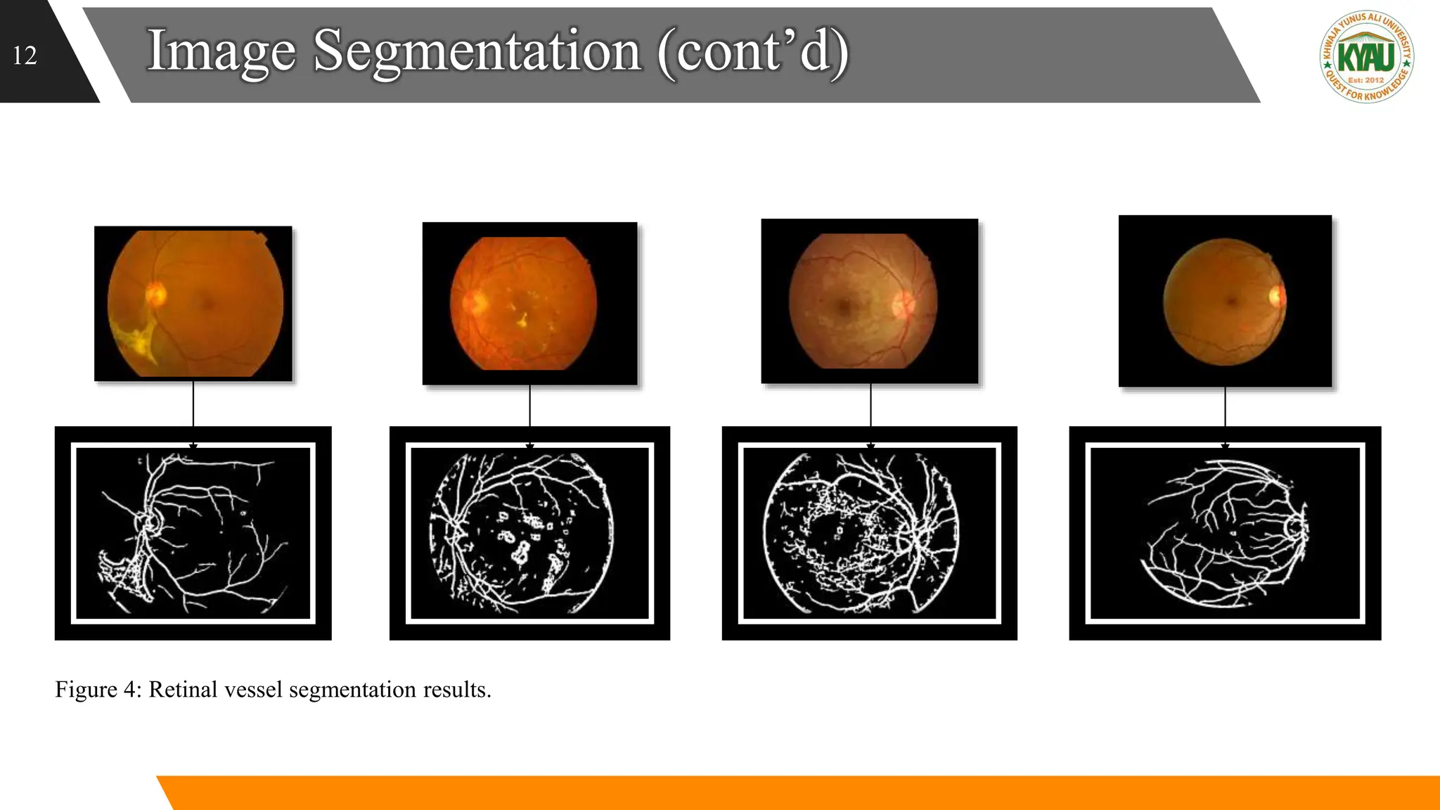 Classification of Diabetic Retinopathy.pptx