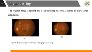 Classification of Diabetic Retinopathy.pptx