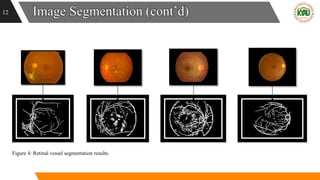 Classification of Diabetic Retinopathy.pptx