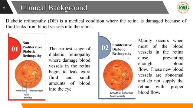 Classification of Diabetic Retinopathy.pptx | Diabetes | Diseases and ...