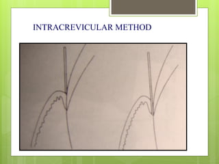 Defense-mechanism-of-gingiva-Dr.-A.-Chaitanya.ppt