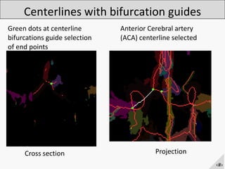 Arterial tortuosity measurement system | PPTX