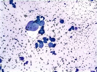 Deferential diagnosis of mesothelial proliferations and neoplasms | PPT