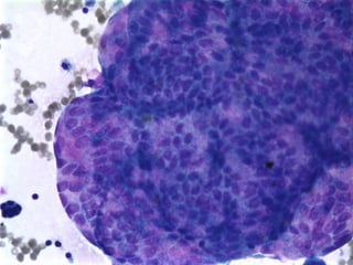 Deferential diagnosis of mesothelial proliferations and neoplasms | PPT