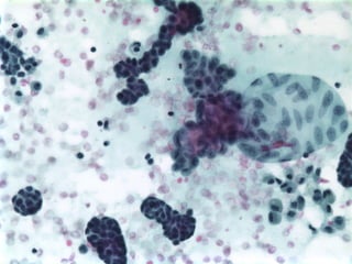 Deferential diagnosis of mesothelial proliferations and neoplasms | PPT