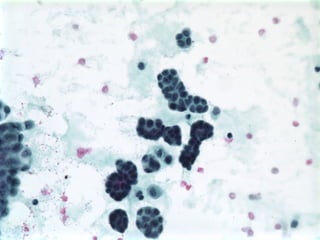 Deferential diagnosis of mesothelial proliferations and neoplasms | PPT
